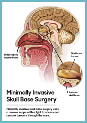 A glimpse inside the mind of neurosurgery expert, Dr. Fahad Alkherayf ...