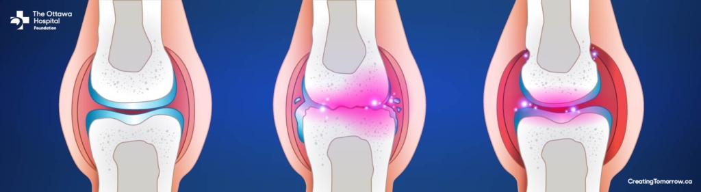 All about rheumatoid arthritis | The Ottawa Hospital Foundation