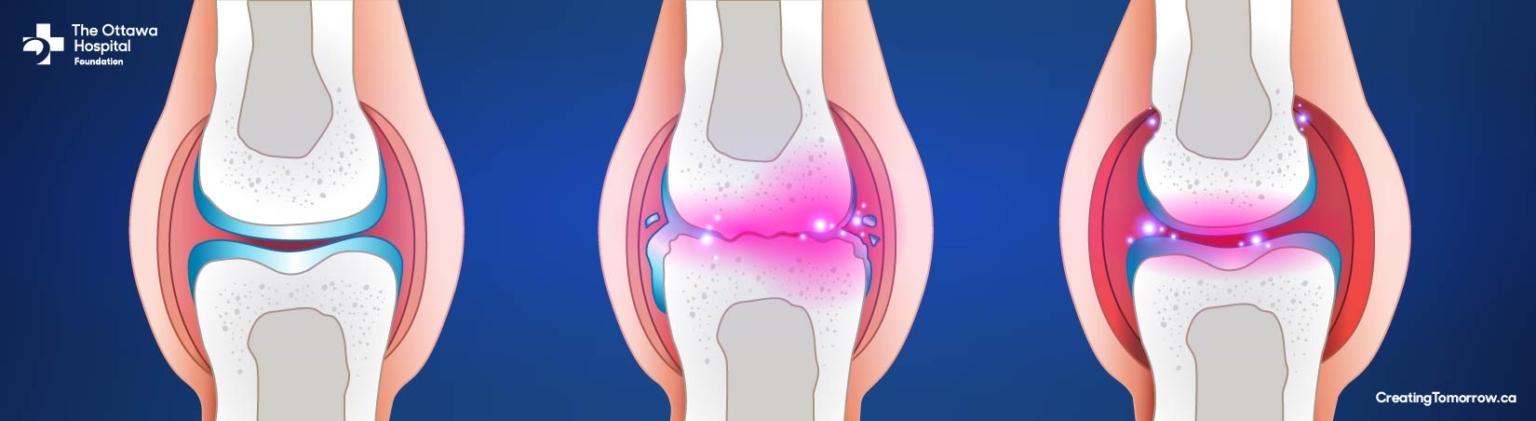 All about rheumatoid arthritis | The Ottawa Hospital Foundation