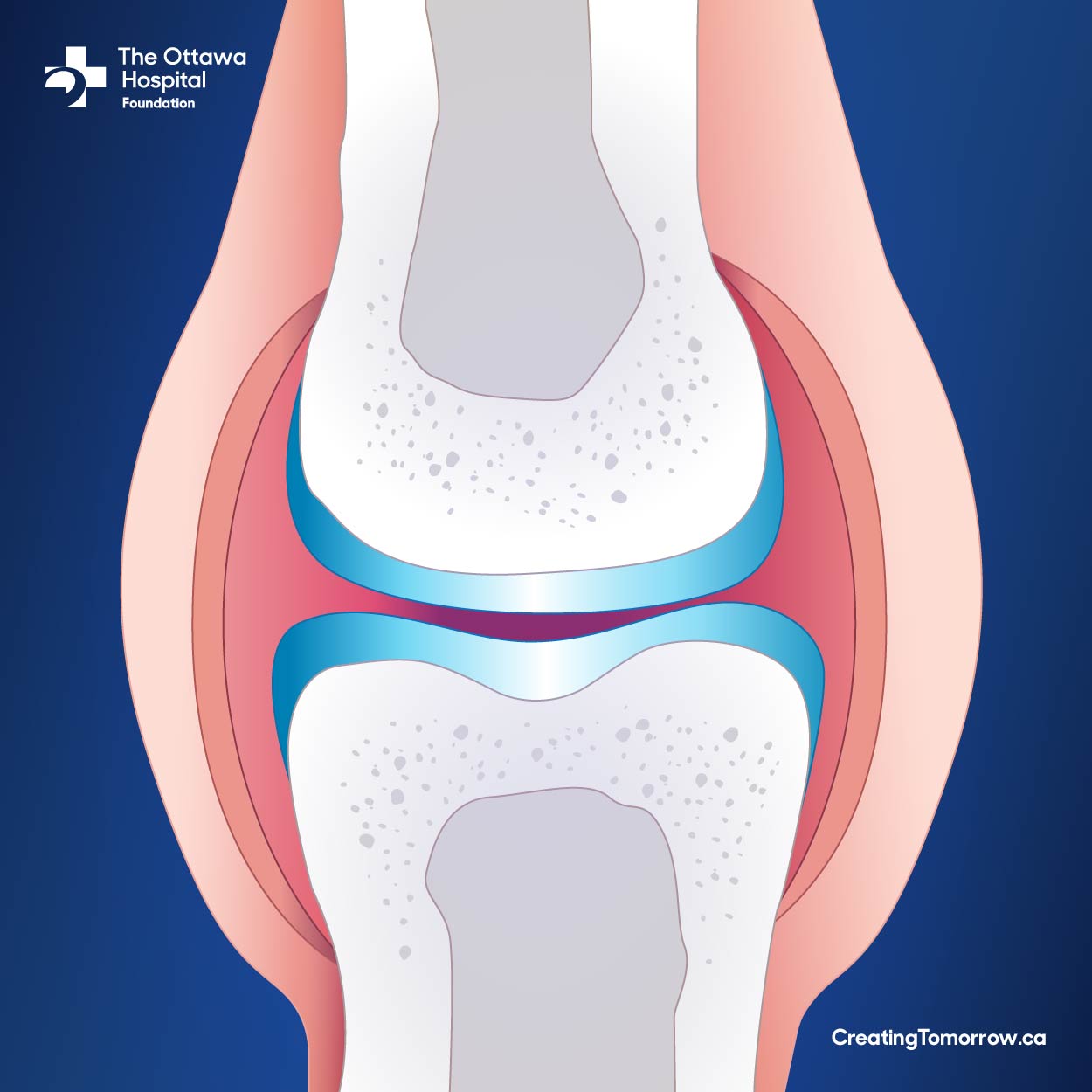 All about rheumatoid arthritis | The Ottawa Hospital Foundation