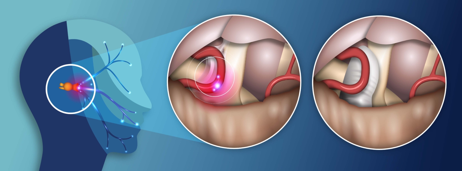 All about trigeminal neuralgia | The Ottawa Hospital Foundation