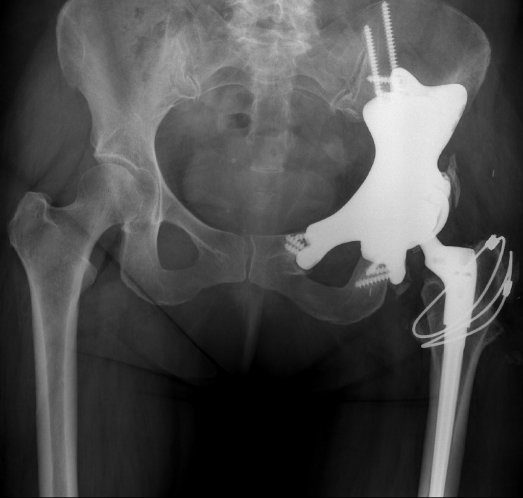 3D custom implant gives new hope for patient with rare bone cancer ...